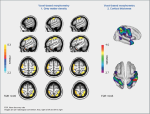 Adult ADHD: The Brain!!