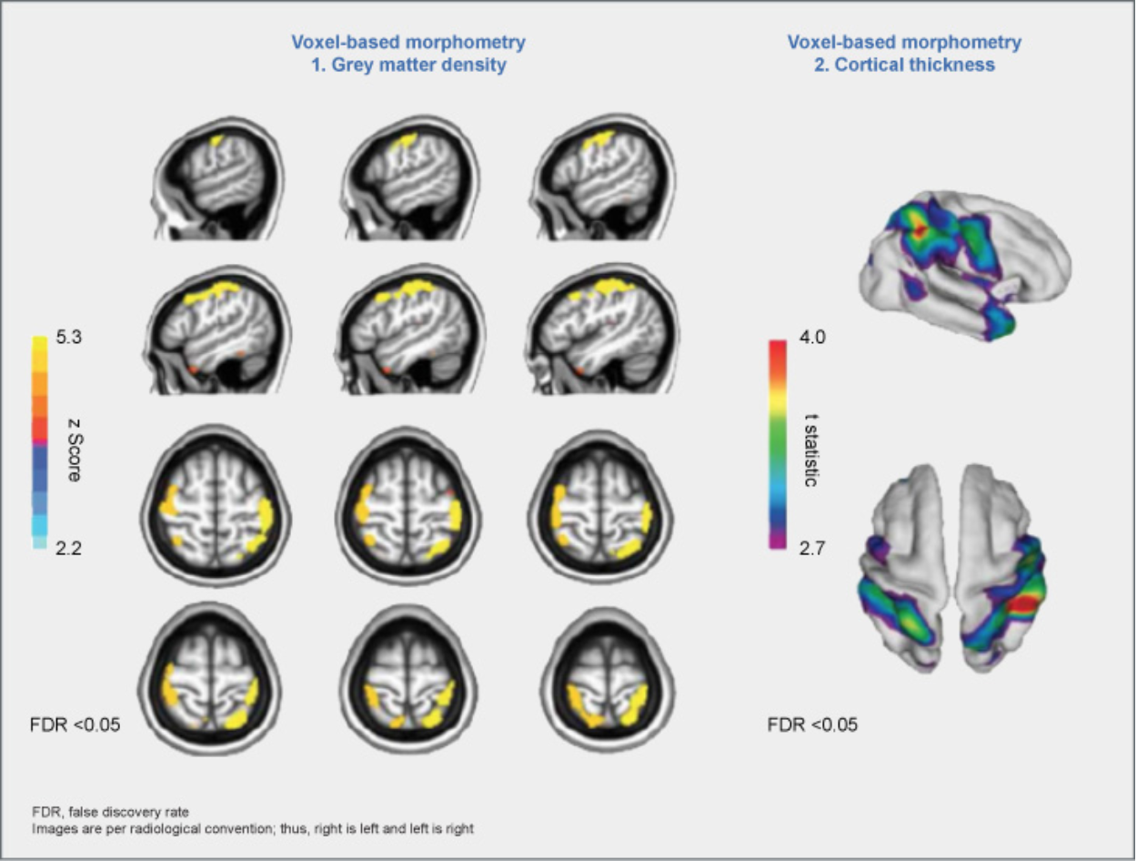 Adult ADHD: The Brain!!